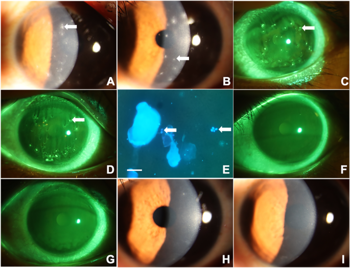 Clinical Analyses of 4 Cases of Microsporidial Keratoconjunctivitis ...