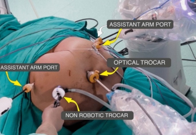 The World’s First Long-Distance Tele-Robotic Bariatric Surgery Using an ...