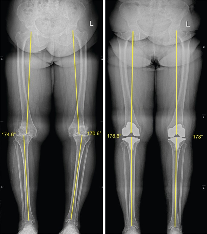 Correction to: Comparison of imageless robotic assisted total knee ...