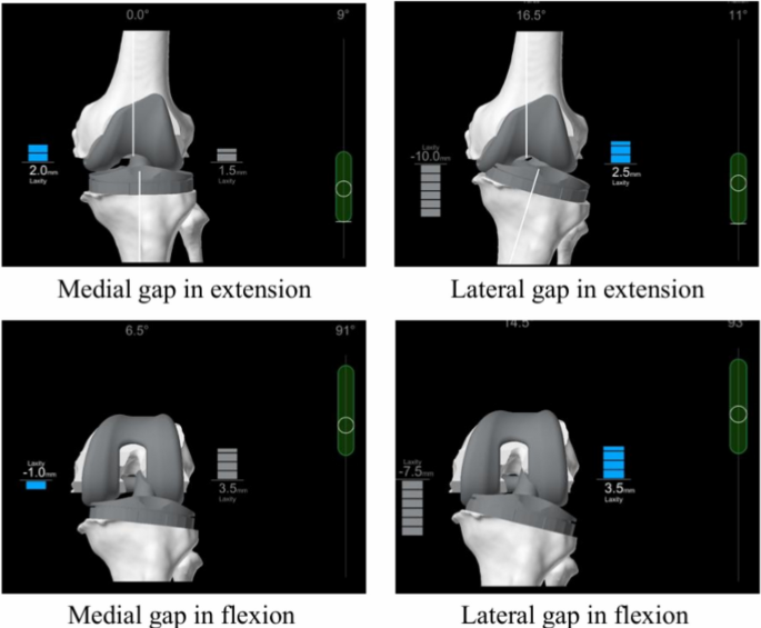 Dynamic joint balancing provides consistent gap prediction without a ...