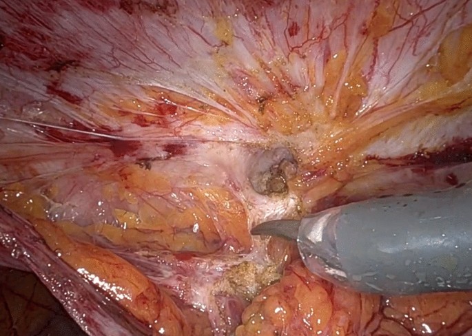 Robotic transabdominal preperitoneal versus laparoscopic ...