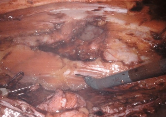 Robotic transabdominal preperitoneal versus laparoscopic ...