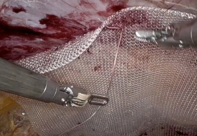 Robotic transabdominal preperitoneal versus laparoscopic intraperitoneal onlay mesh plus repair ...