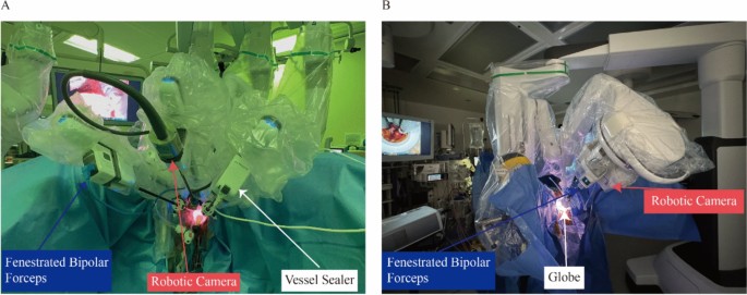 Large uterus as a surgical challenge in robot-assisted vNOTES ...