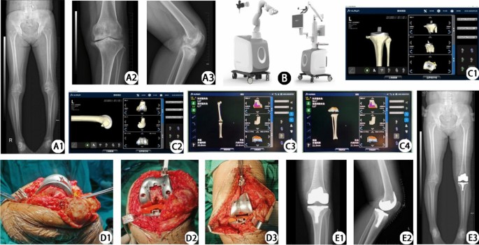 Application and postoperative rehabilitation effects of HURWA, Cori ...