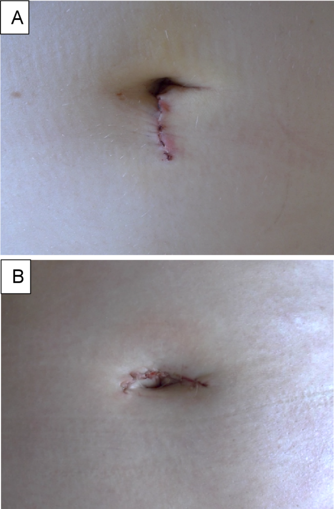 Single-port robotic surgery in gynecology: first experience in German ...
