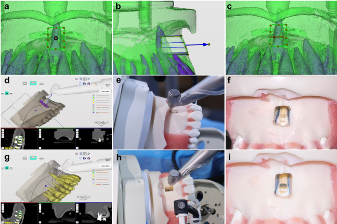 Trueness analysis of a robot-assisted system for maxillary ...