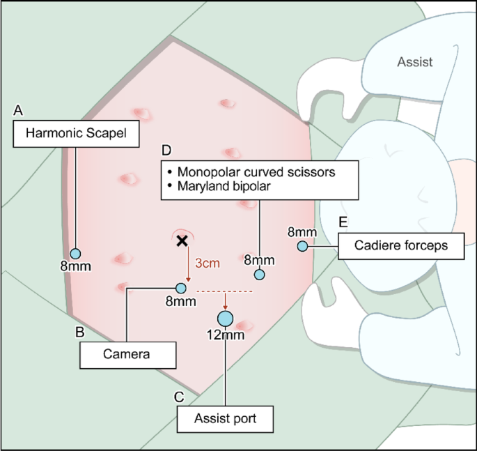 A swine model for surgical training in various types of robotic liver ...