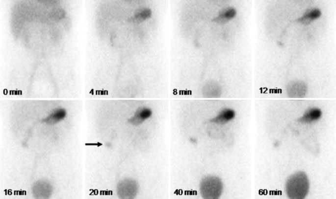 Ectopic gastric mucosa in “ectopic” Meckel’s diverticulum | SpringerLink