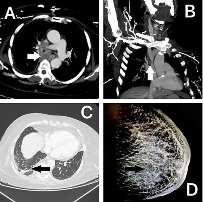 Primary signet ring cell carcinoma of the lung in patient with superior ...