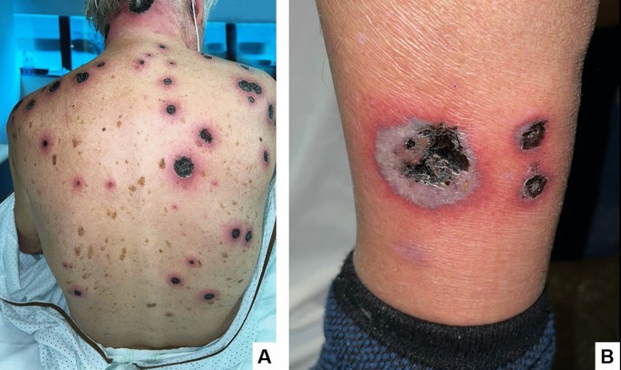Ecthyma gangrenosum of atypical origin | Internal and Emergency Medicine