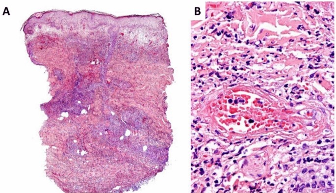 Ecthyma gangrenosum of atypical origin | Internal and Emergency Medicine