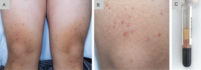 A sudden appearance of pink-yellow papules: the grave and pressing ...