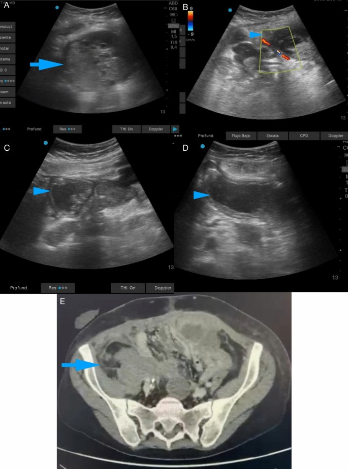 Utility of PoCUS in the complications of inflammatory bowel disease ...