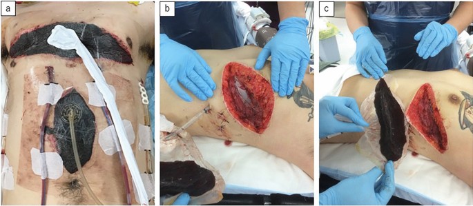Temporary chest closure and open chest management for severe chest ...