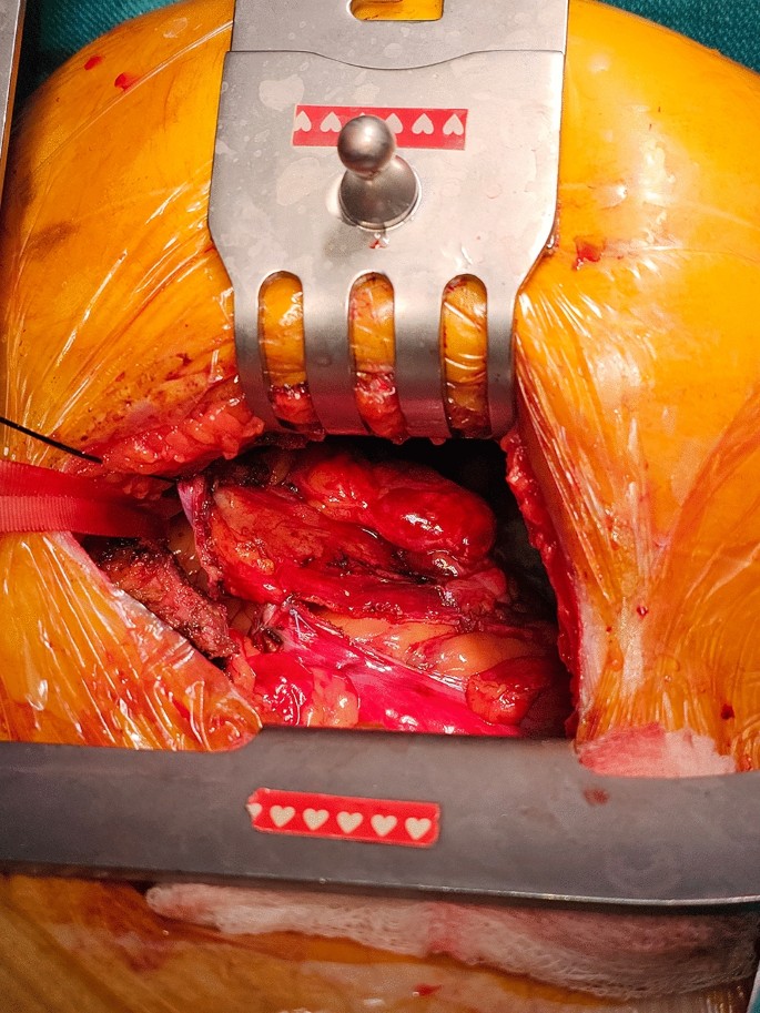 Effect of posterior pericardiotomy on atrial fibrillation in minimally ...