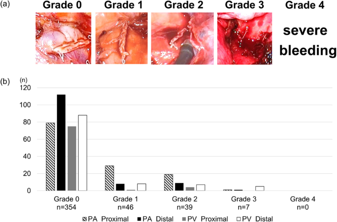 Risk factors for vascular oozing or bleeding following transection with ...