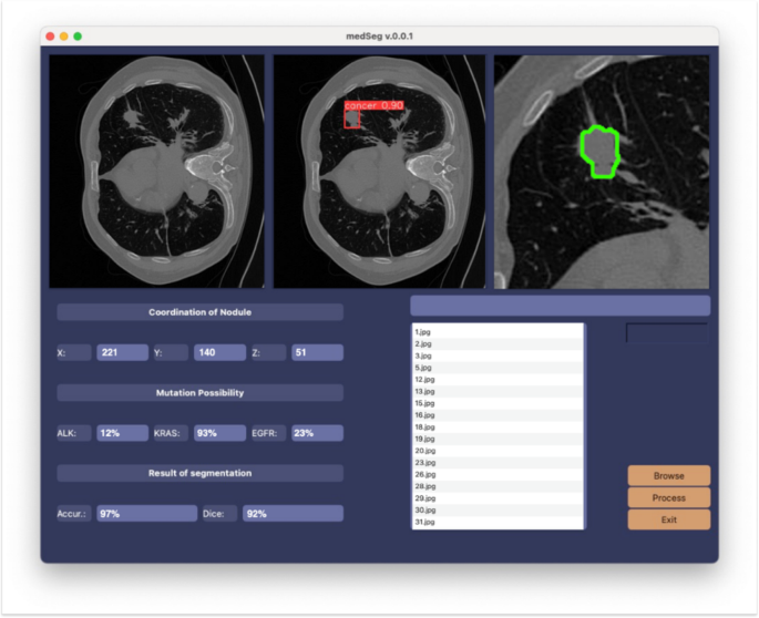 AI-Driven Precision Oncology: Integrating Deep Learning, Radiomics, and ...