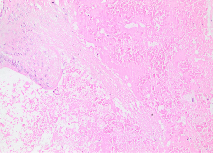 Prognostic significance of necrosis in ampullary carcinomas | Irish ...