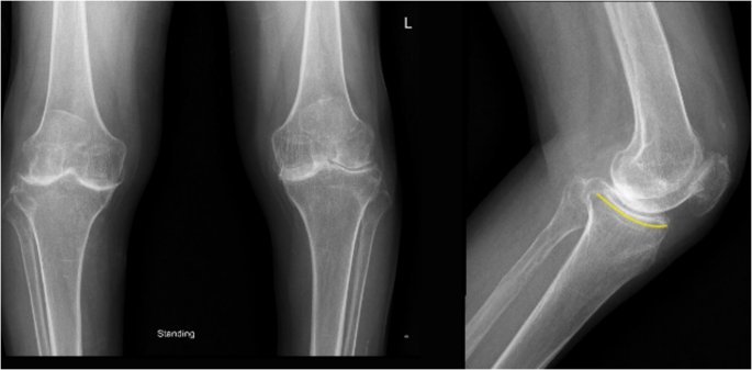 Total knee arthroplasty in ochronosis: a case of intraoperative ...