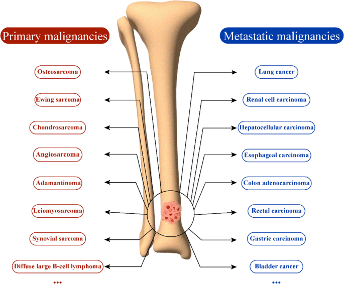 Advances in Surgical Management of Malignant Tumors of the Distal Tibia ...