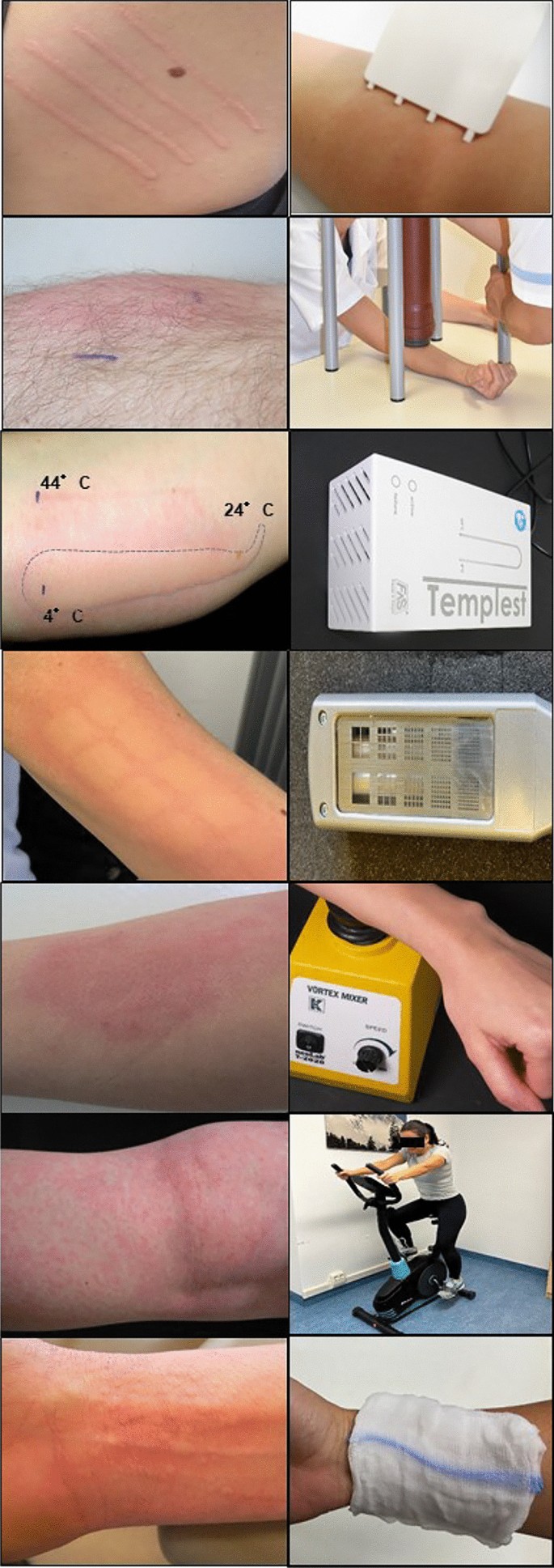 New insights into chronic inducible urticaria | Current Allergy and ...