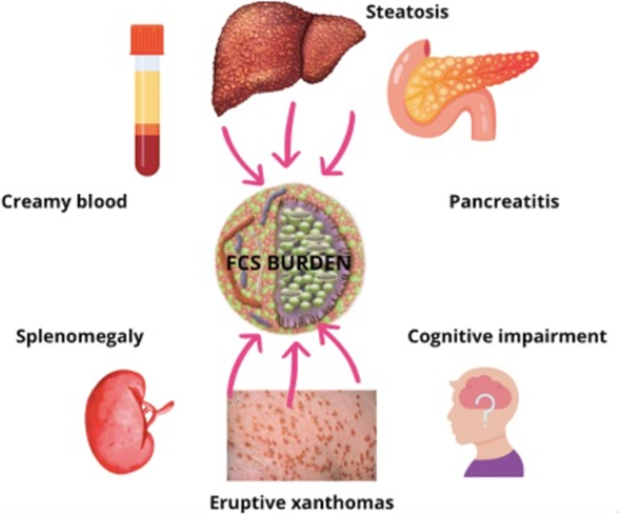 Novel Therapeutics for Familial Chylomicronemia Syndrome | Current ...
