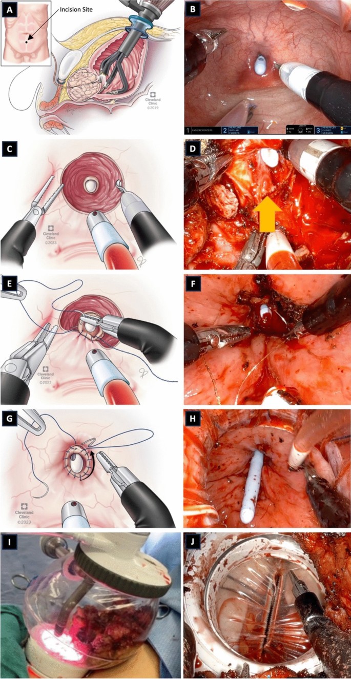 Single Port Robot-Assisted Simple Prostatectomy | Current Bladder ...