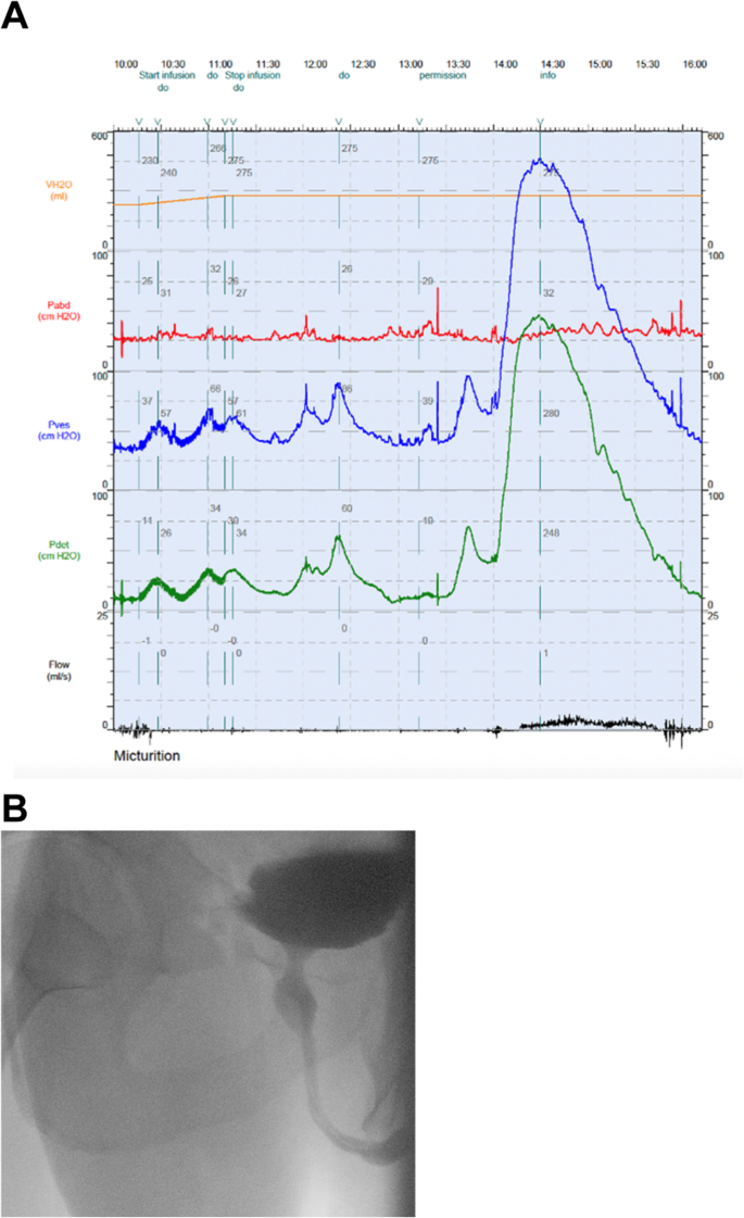 Videourodynamics for Male Lower Urinary Tract Symptoms: Indications and ...
