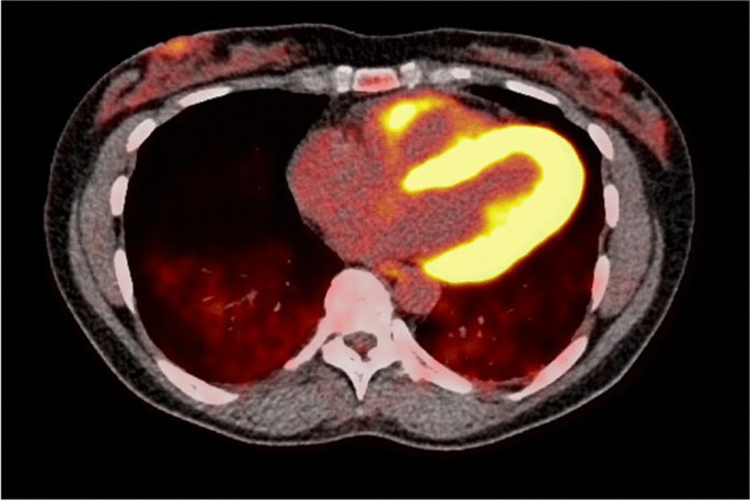 Cardiac Sarcoidosis: Utilizing Cardiac MRI and PET-CT | Current ...