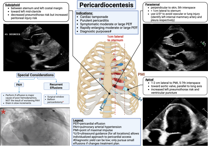 Pericardiocentesis: History, Current Practice, and Future Directions ...