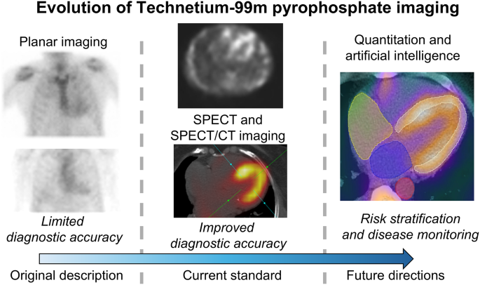 The Accuracy of Technetium-99 m Pyrophosphate Imaging in Diagnosing ...