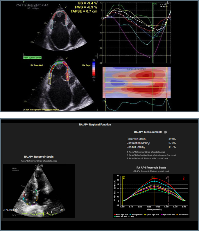Echocardiographic Evaluation of Pulmonary Hypertension: A Contemporary ...