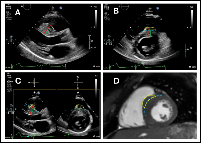 Echocardiography in Athletes: the Ever-Evolving Assessment of ...