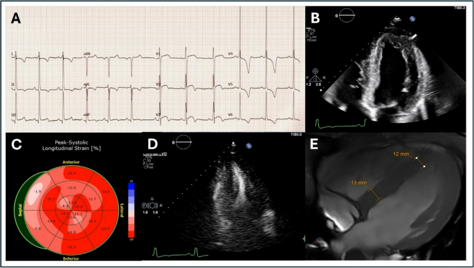 Echocardiography in Athletes: the Ever-Evolving Assessment of ...