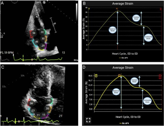 Echocardiographic Deformation Imaging of the Right Atrium: A New ...