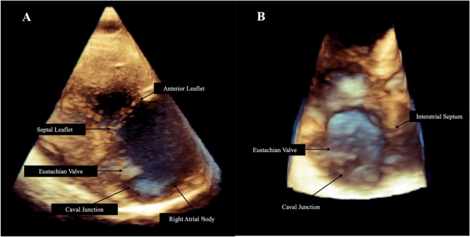 Echocardiographic Deformation Imaging of the Right Atrium: A New ...