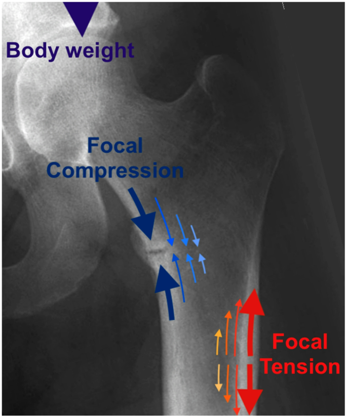 Pathophysiology of Femoral Fractures in Hypophosphatasia | Current ...