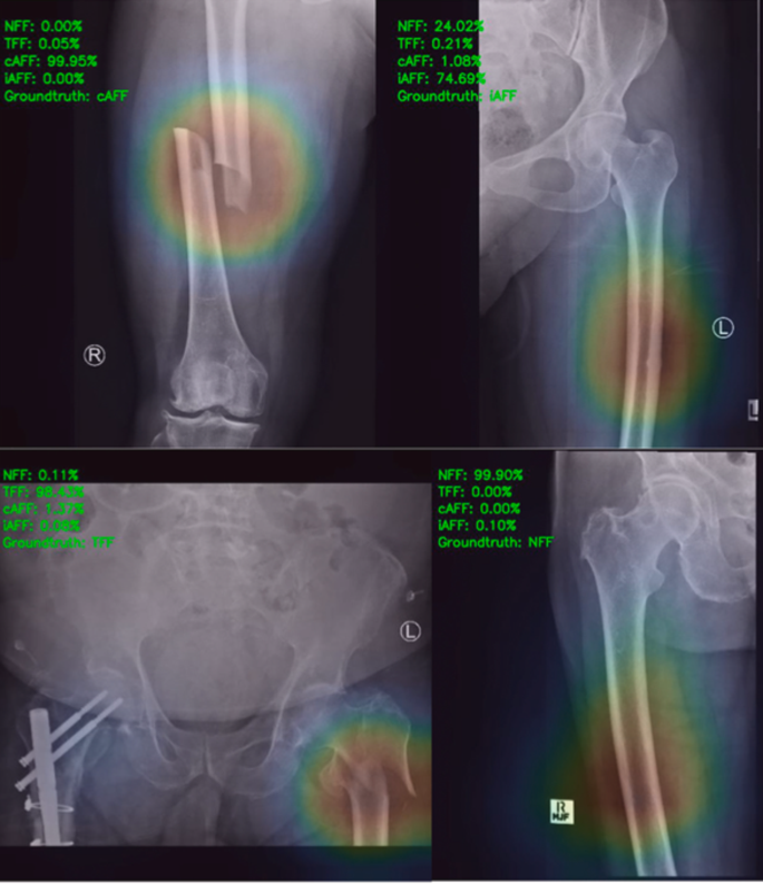 Epidemiology, Pathophysiology and Management of Atypical Femur ...