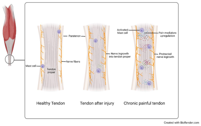 Is Chronic Tendon Pain Caused by Neuropathy? Exciting Breakthroughs may ...