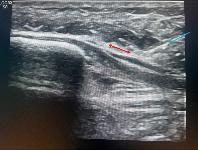 Is Chronic Tendon Pain Caused by Neuropathy? Exciting Breakthroughs may ...