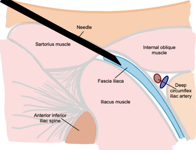 Efficacy of Suprainguinal Fascia Iliaca Block for Pain Management in ...