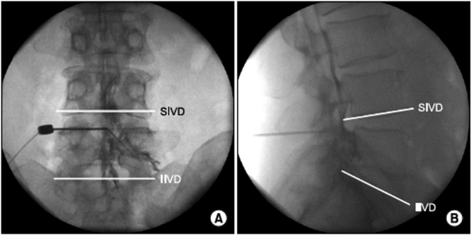 Epidural Contrast Patterns and Clinical Implications: An Educational ...