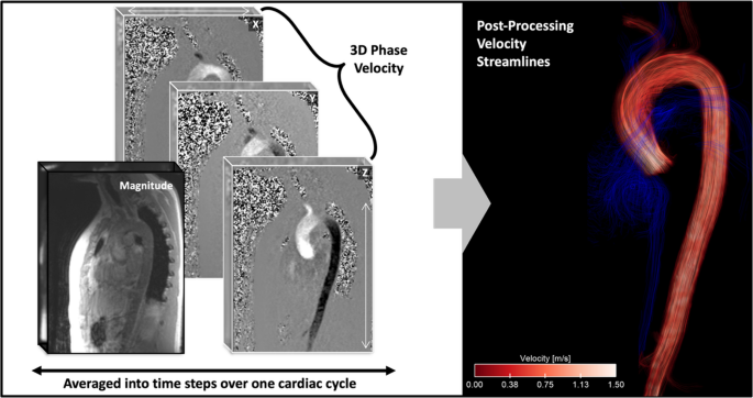 Emerging Trends in Application of Phase Contrast MRI in Vascular ...