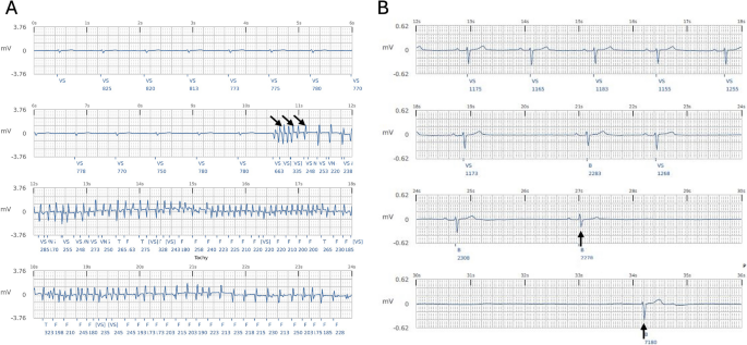Treatment of Epilepsy in Patients with Cardiovascular Disease | Current ...
