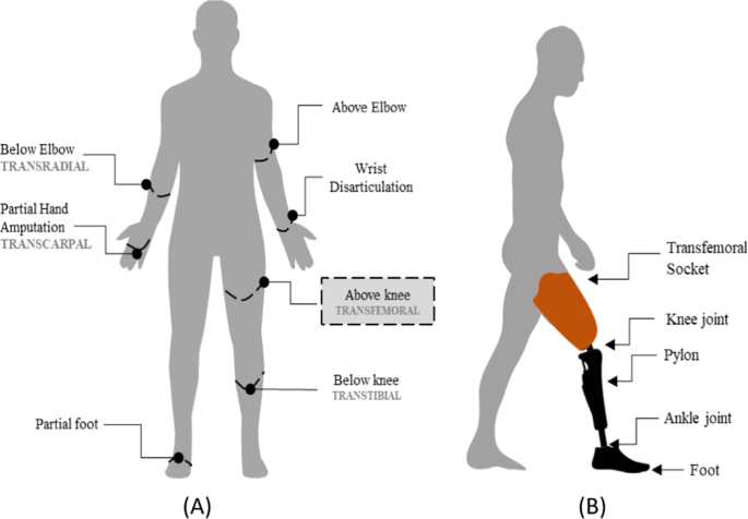 Fabrication of transfemoral prosthesis utilizing additive manufacturing ...