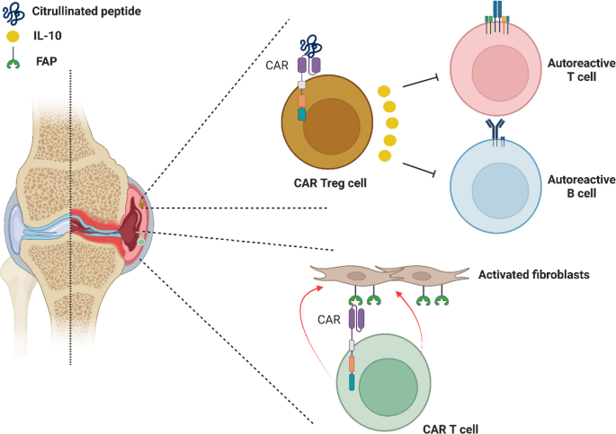 CAR T Cell Therapy for Rheumatoid Arthritis | Clinical Reviews in ...