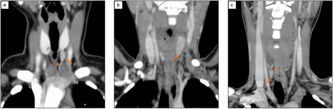 The polar vessel sign: insights from CT imaging analysis in Asian ...
