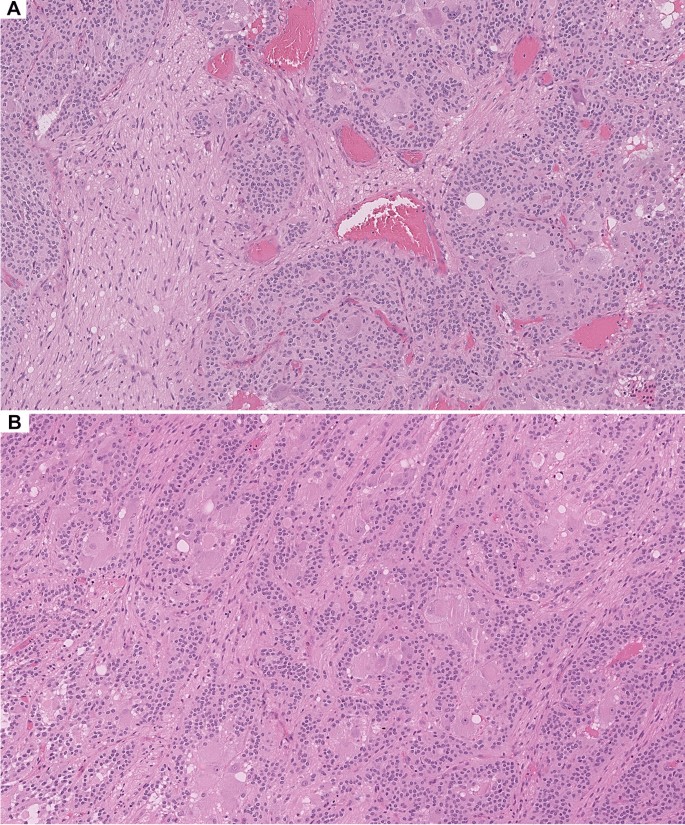 Cauda Equina Neuroendocrine Tumors with Ganglioneuromatous Elements are ...