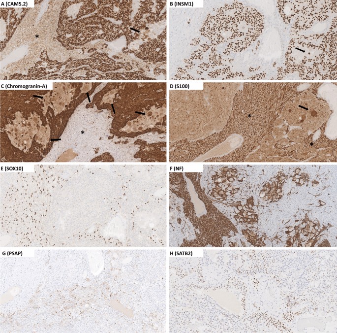 Cauda Equina Neuroendocrine Tumors with Ganglioneuromatous Elements are ...